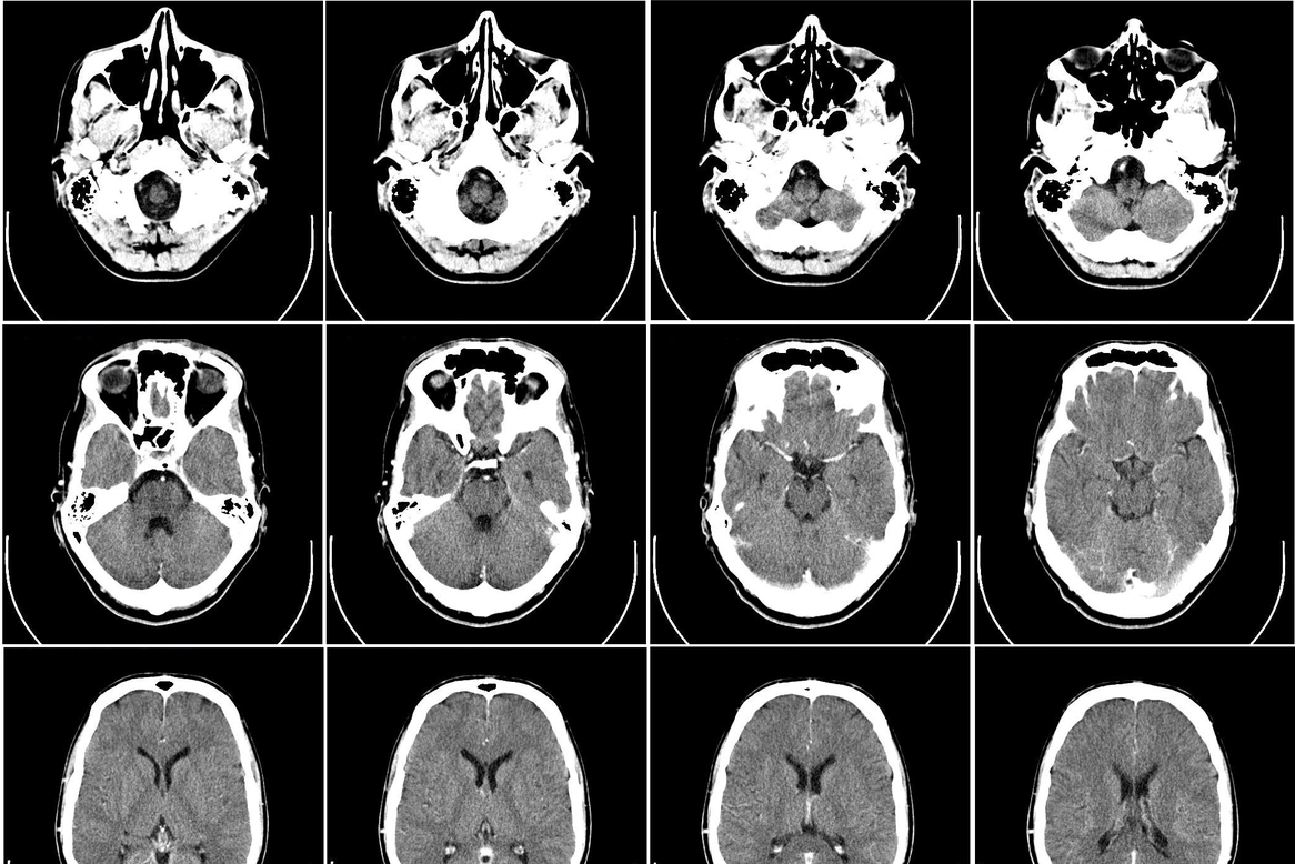 The Enigmas of Foreign Accent Syndrome | Science History Institute